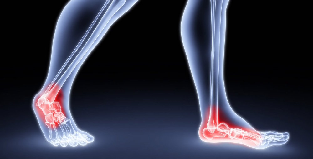 EVFAS Post Traumatic Arthritis EVFAS Post Traumatic Arthritis